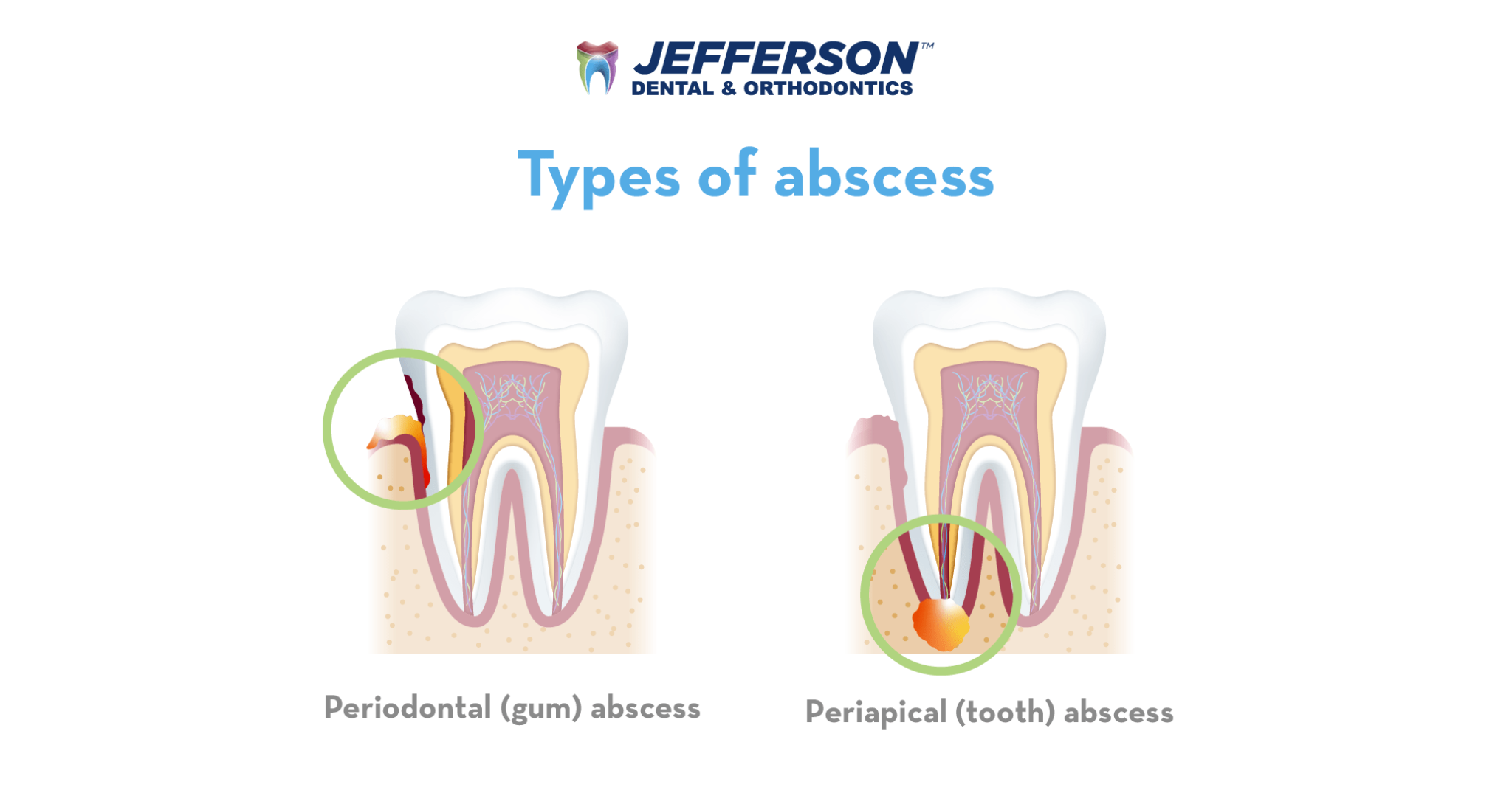 Abscessed Tooth: Types, Causes, Symptoms and Treatment | Jefferson ...