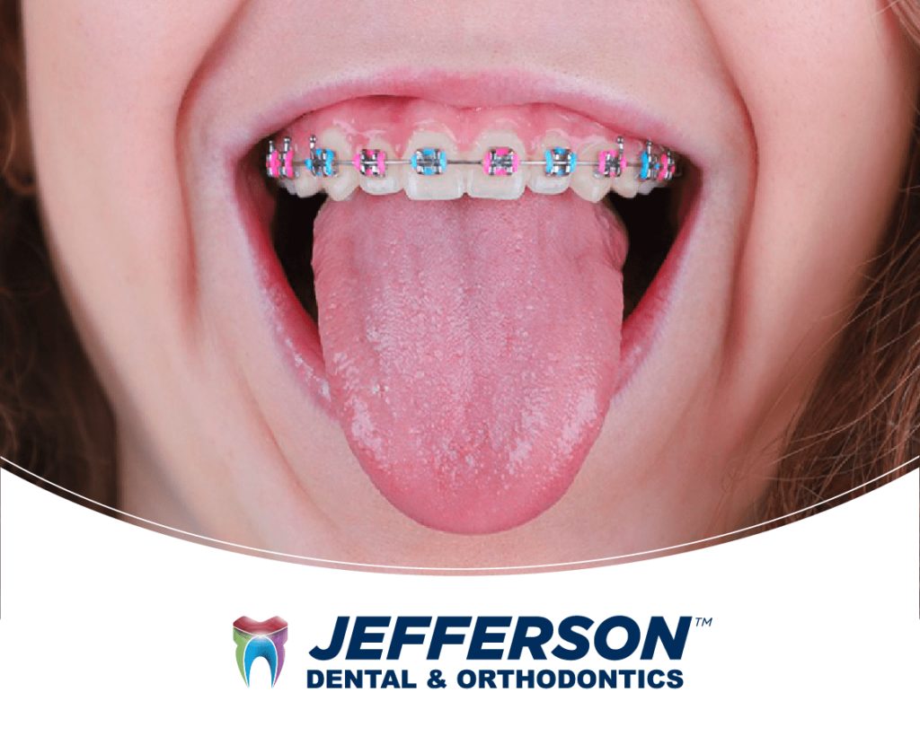 Braces Colors: How to Pick the Best Braces Color for Your Teeth ...