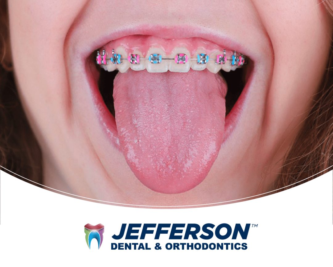 Braces Colors: How to Pick the Best Braces Color for Your Teeth ...
