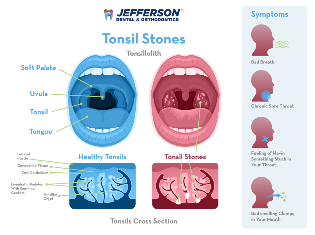 Tonsil Stones: Causes, Symptoms, Treatment & Prevention | Jefferson Dental & Orthodontics