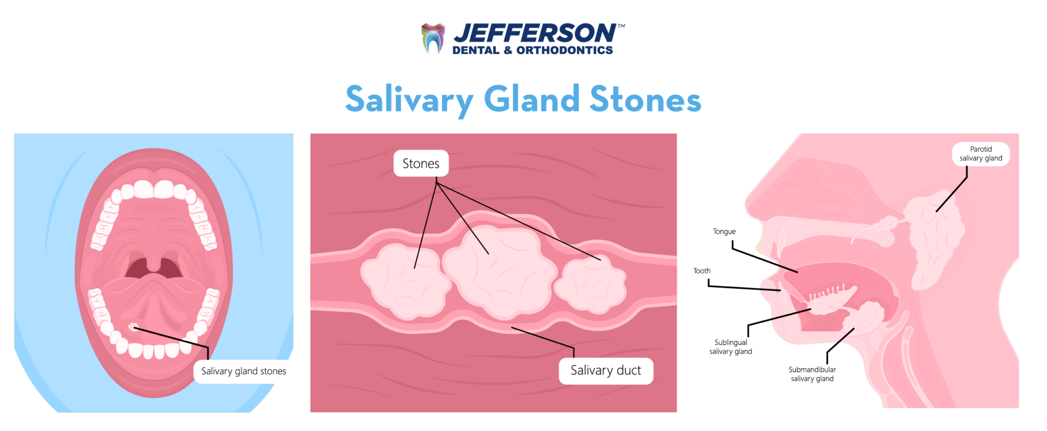 Salivary Gland Stones: Symptoms, Causes & Treatment | Jefferson Dental ...
