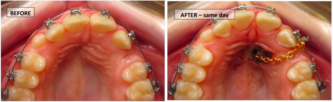 Exposure and Bonding Dental Procedure - JeffersonDental & Orthodontics