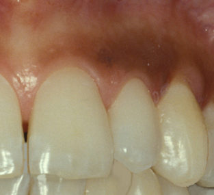 Why Are My Gums Black? What Causes Changes in Gum Color | Jefferson ...