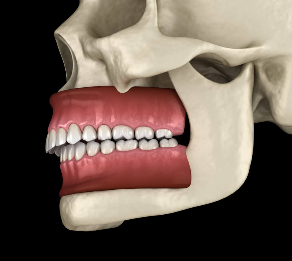 What Is an Overbite and How To Correct It | Jefferson Dental & Orthodontics